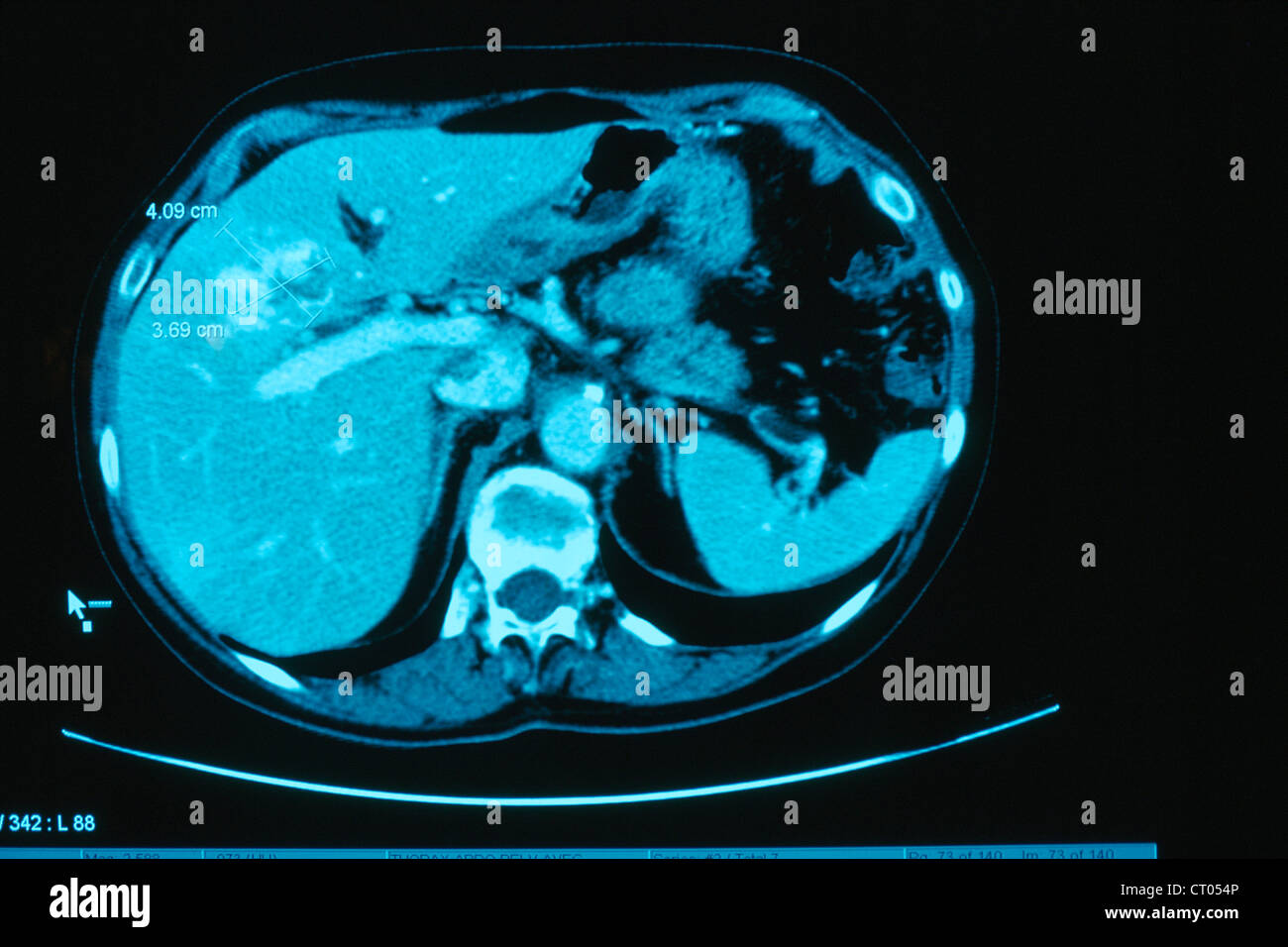 CANCER OF THE LIVER, SCAN Stock Photo - Alamy