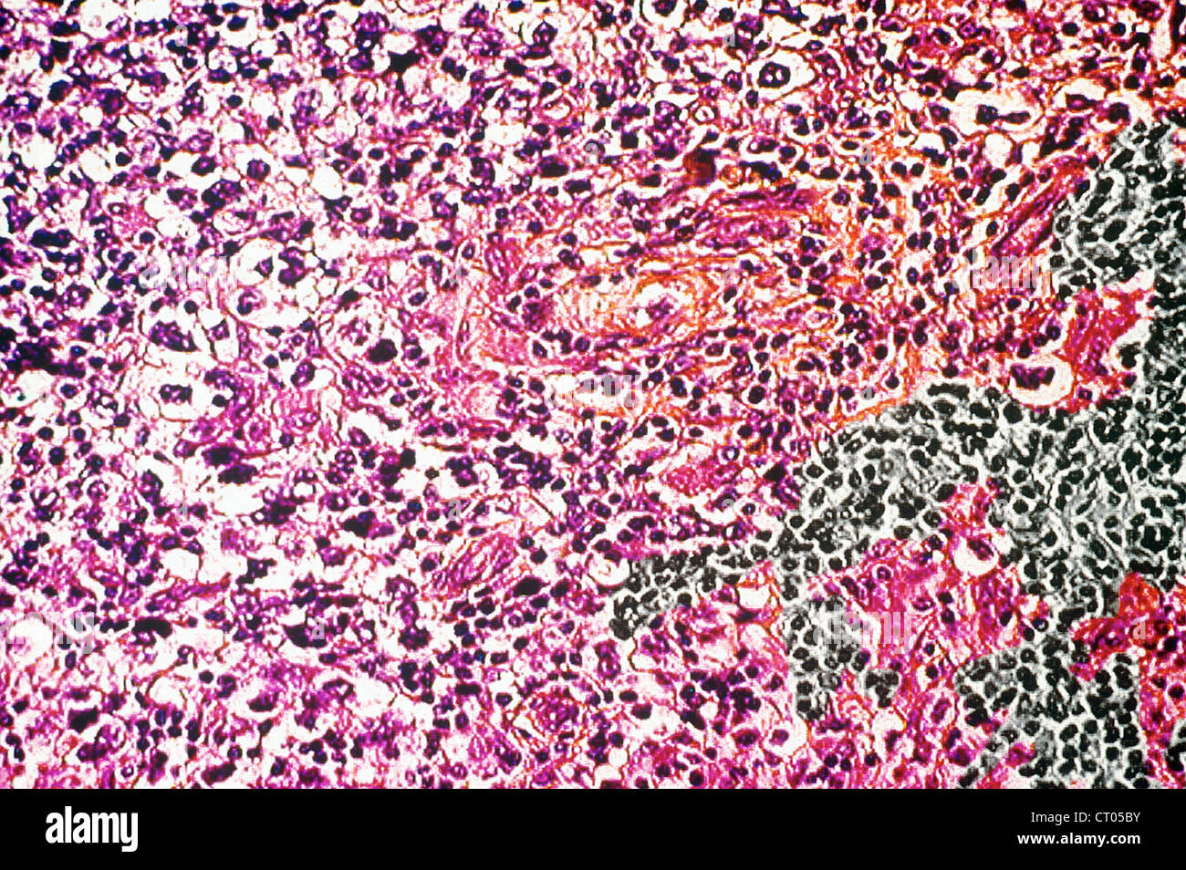 Seminoma hi-res stock photography and images - Alamy