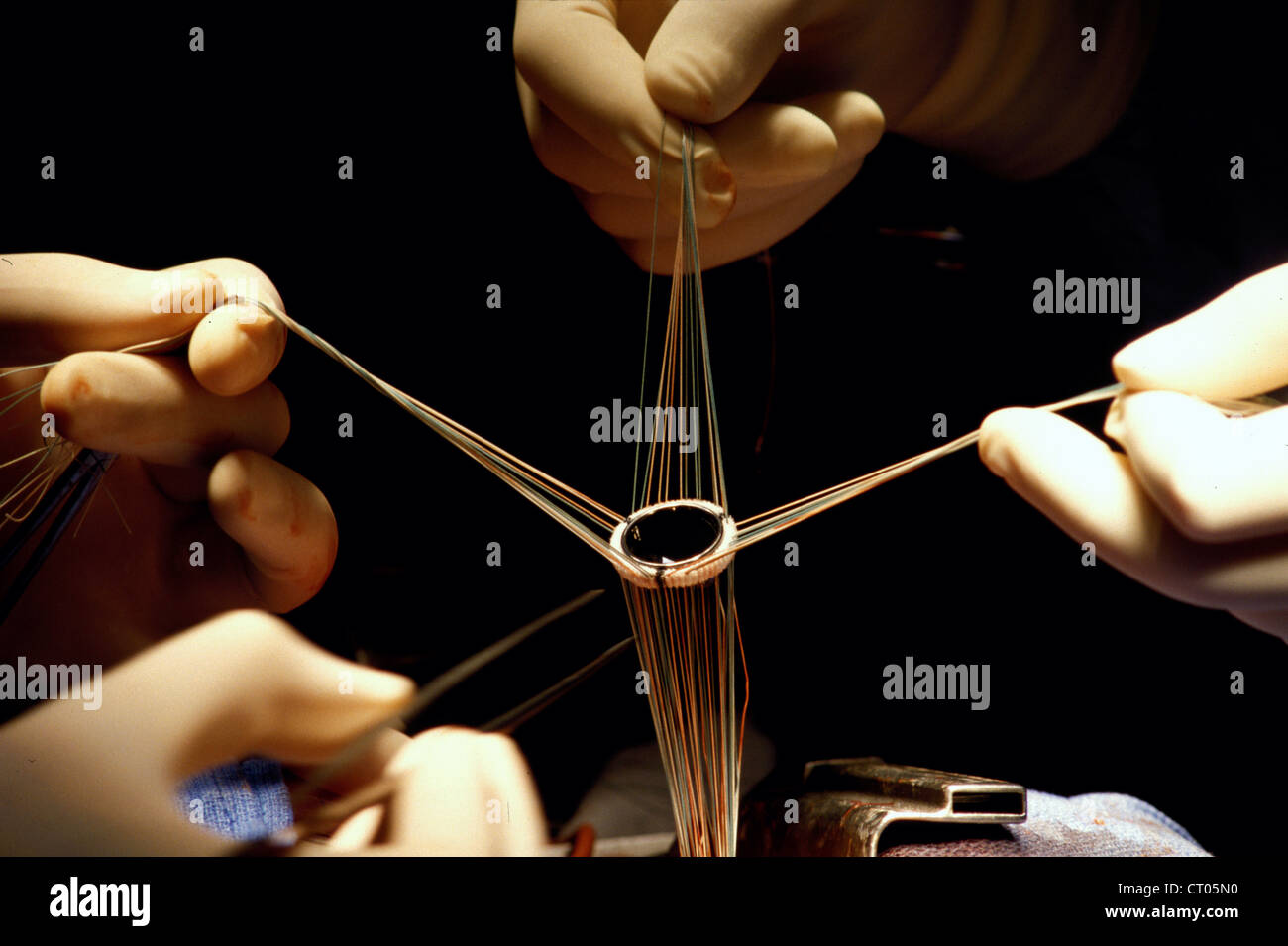 HEART VALVE PROSTHESIS Stock Photo - Alamy