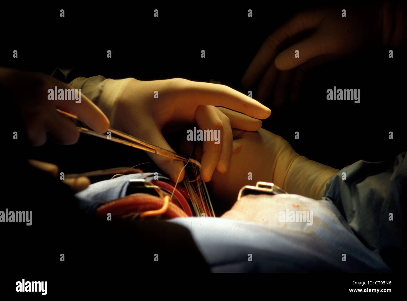 HEART VALVE PROSTHESIS Stock Photo - Alamy