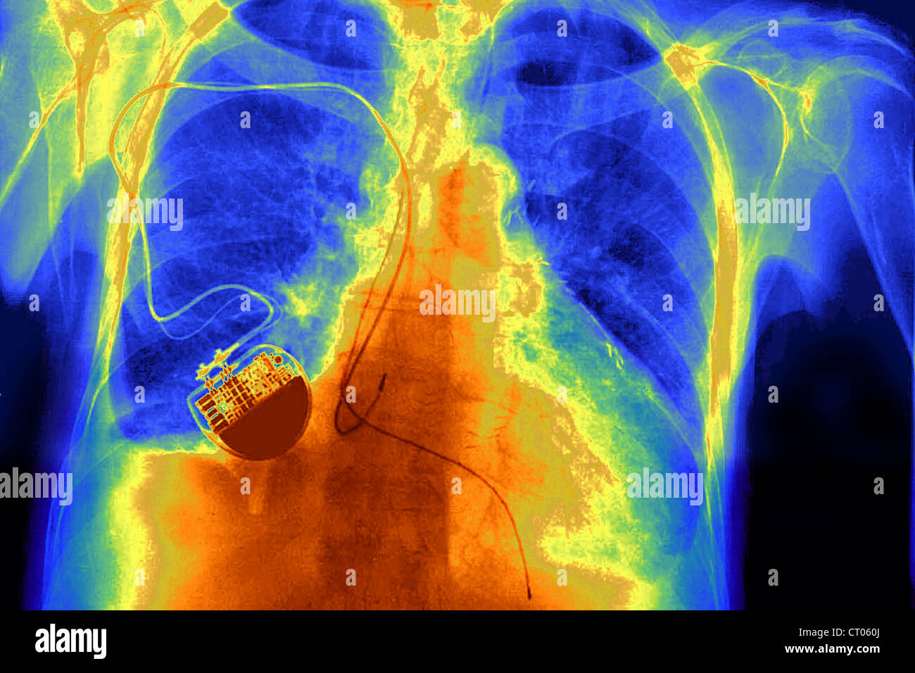Heart pacemaker x ray hi-res stock photography and images - Alamy