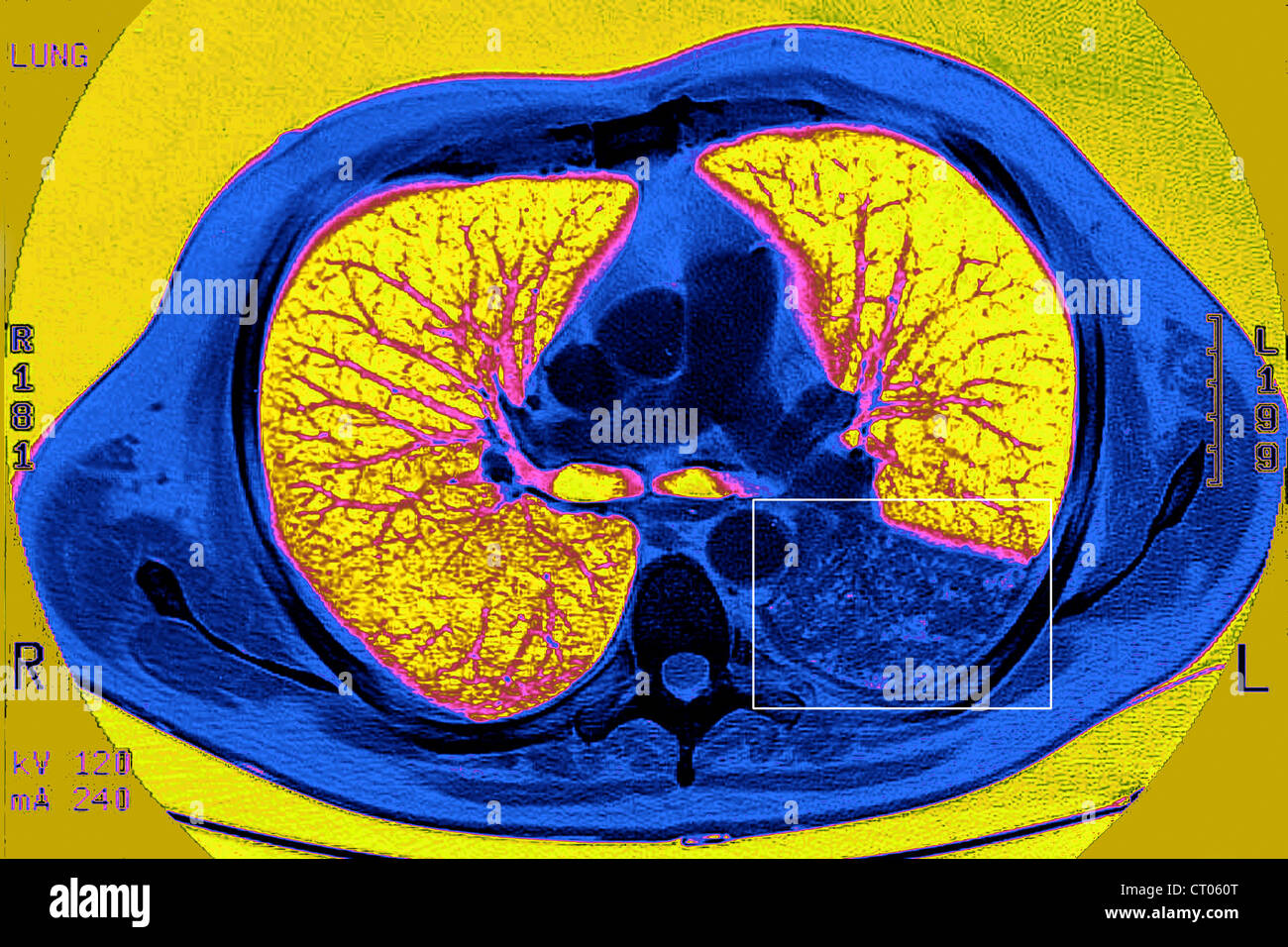 PNEUMOCOCCAL PNEUMONIA, SCAN Stock Photo - Alamy