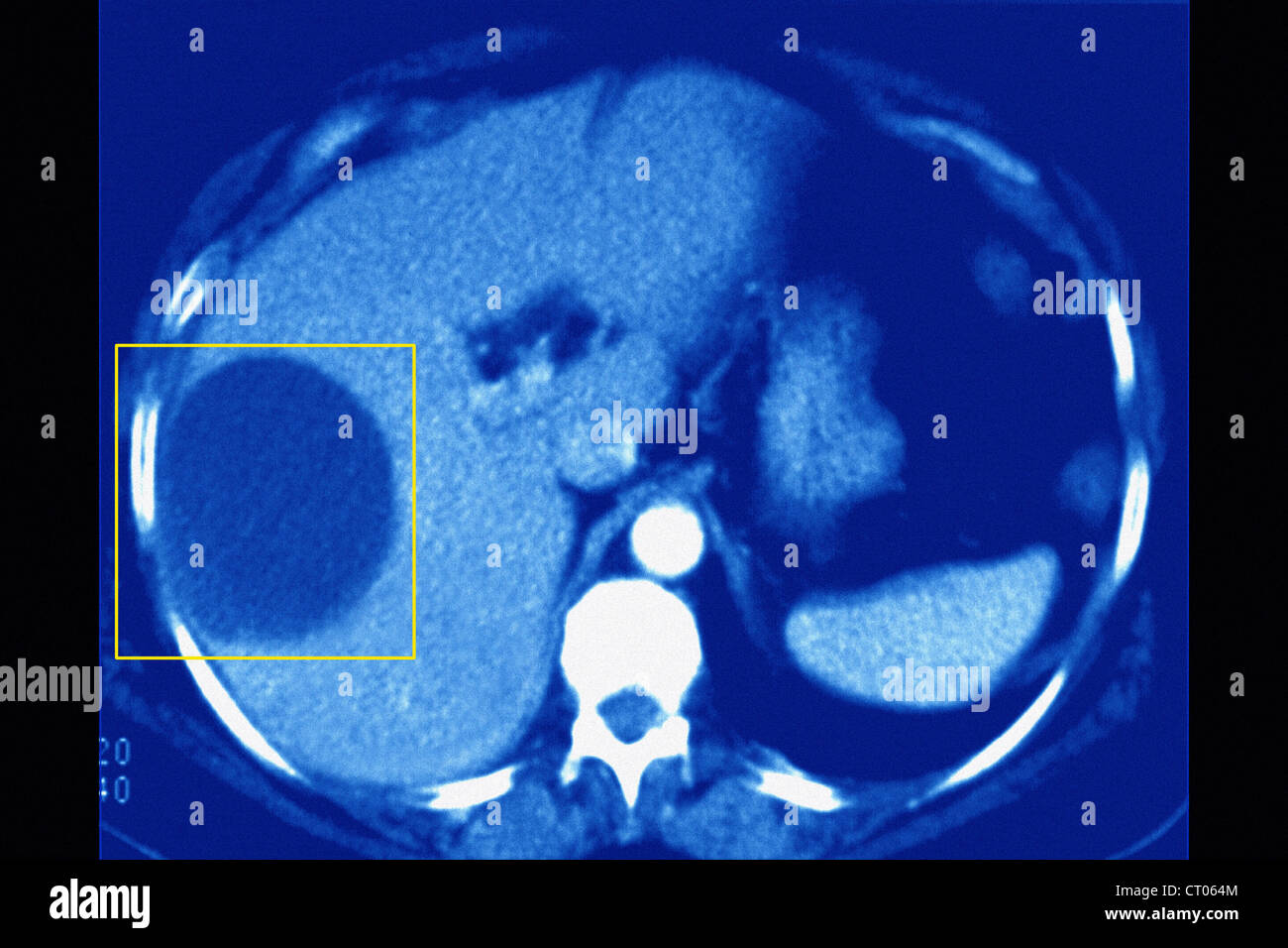 Liver cyst hi-res stock photography and images - Alamy