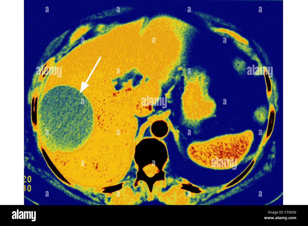 Liver cyst hi-res stock photography and images - Alamy