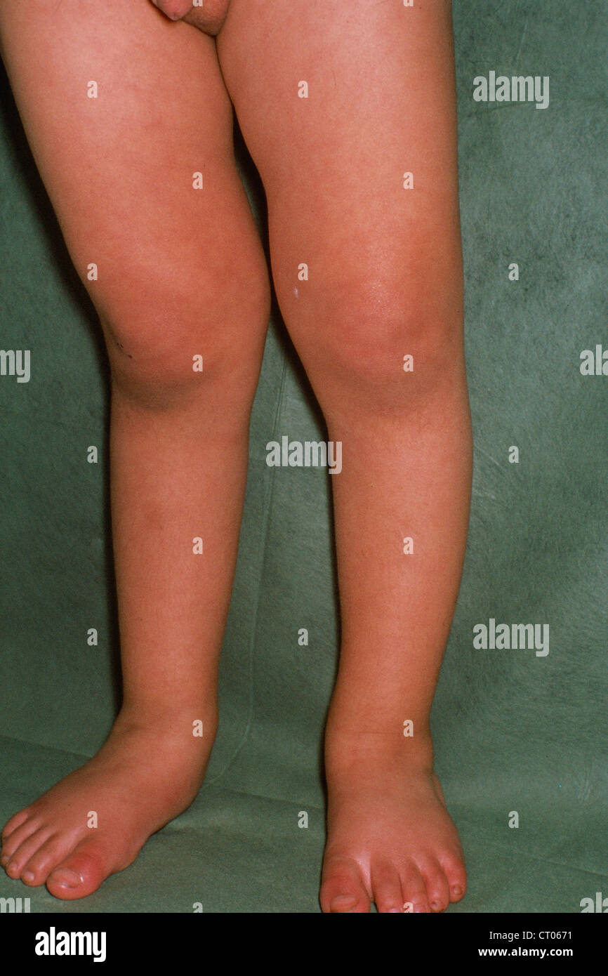 Rickets hi-res stock photography and images - Alamy