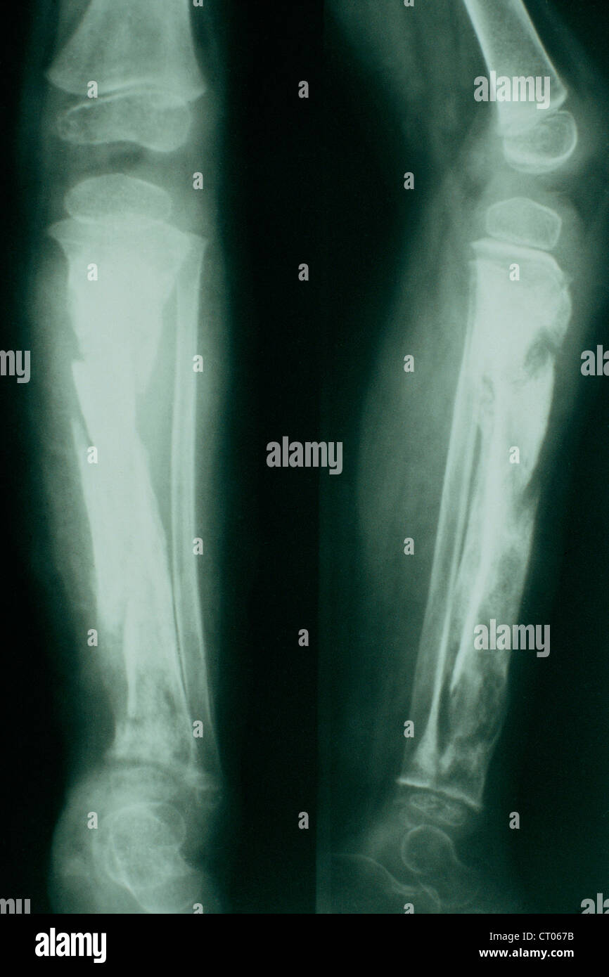 Osteomyelitis hi-res stock photography and images - Alamy