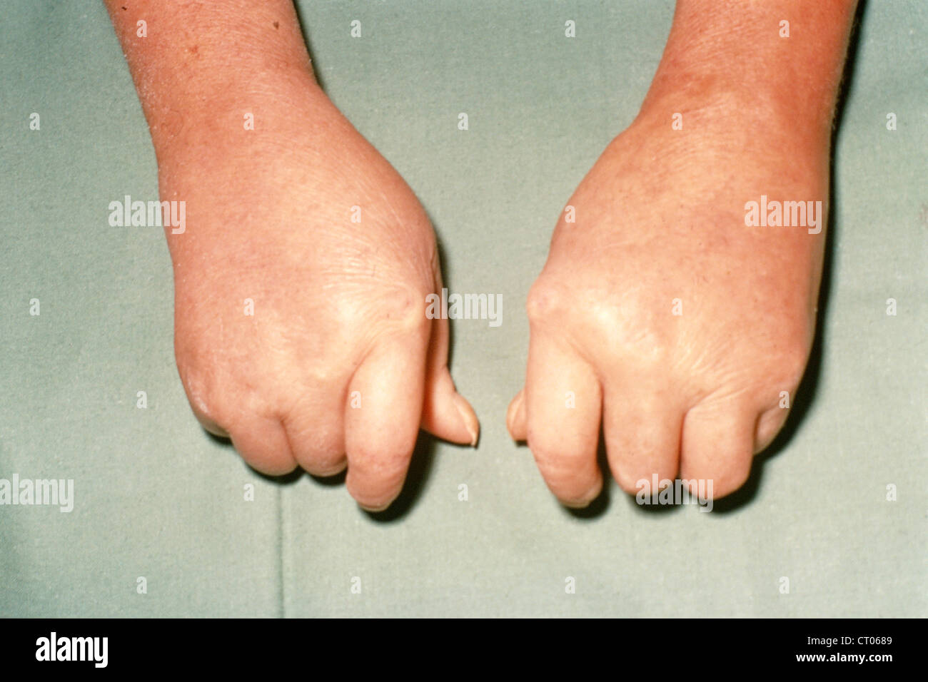 Scleroderma hands hi-res stock photography and images - Alamy