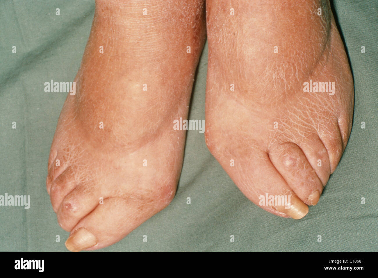 Feet Problems And Scleroderma