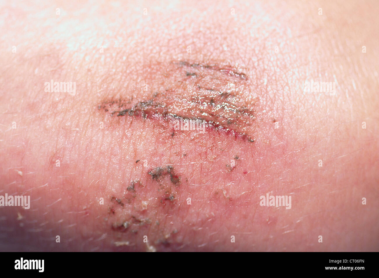 Child scab knee hi-res stock photography and images - Alamy