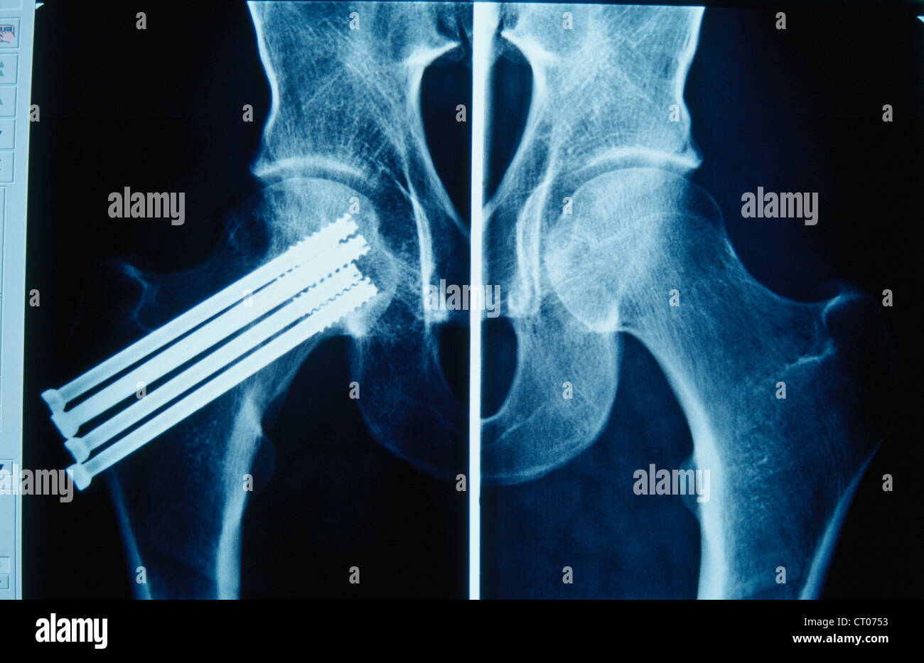 FEMUR OSTEOSYNTHESIS, X-RAY Stock Photo - Alamy