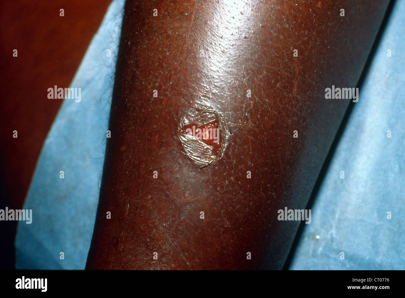 Filariasis hi-res stock photography and images - Alamy