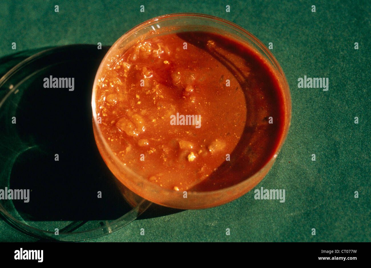 Intestinal amebiasis infection hi-res stock photography and images - Alamy