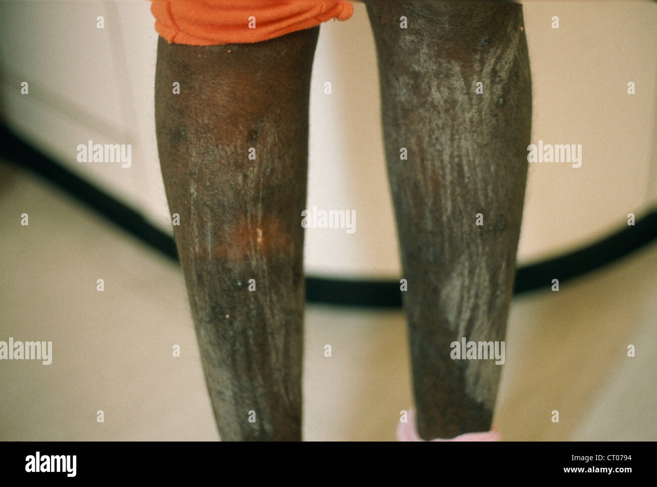 Onchocerciasis hi-res stock photography and images - Alamy