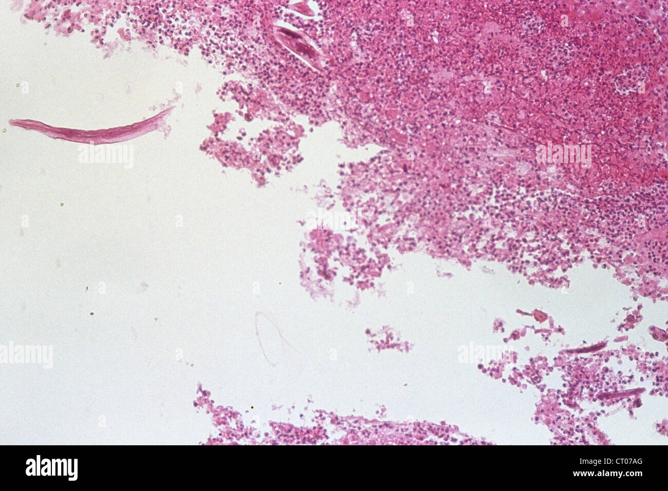 Strongyloides stercoralis hi-res stock photography and images - Alamy