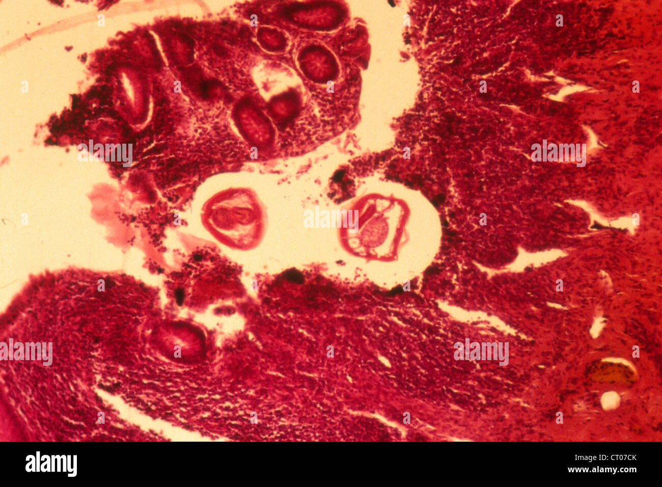 Parasites and pinworms hi-res stock photography and images - Alamy