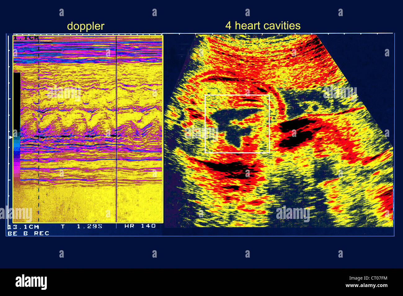 ULTRASOUND BIOMETRY OF THE FETUS Stock Photo - Alamy