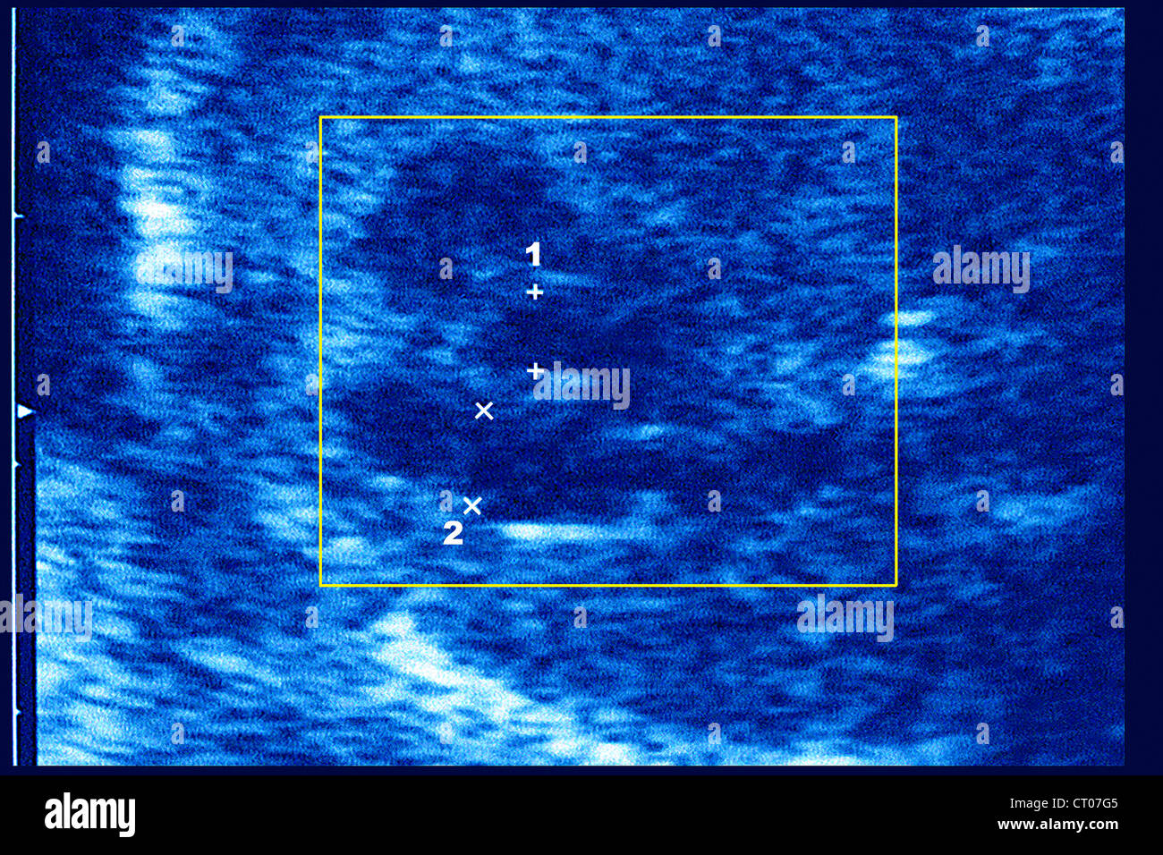 ULTRASOUND BIOMETRY OF THE FETUS Stock Photo - Alamy