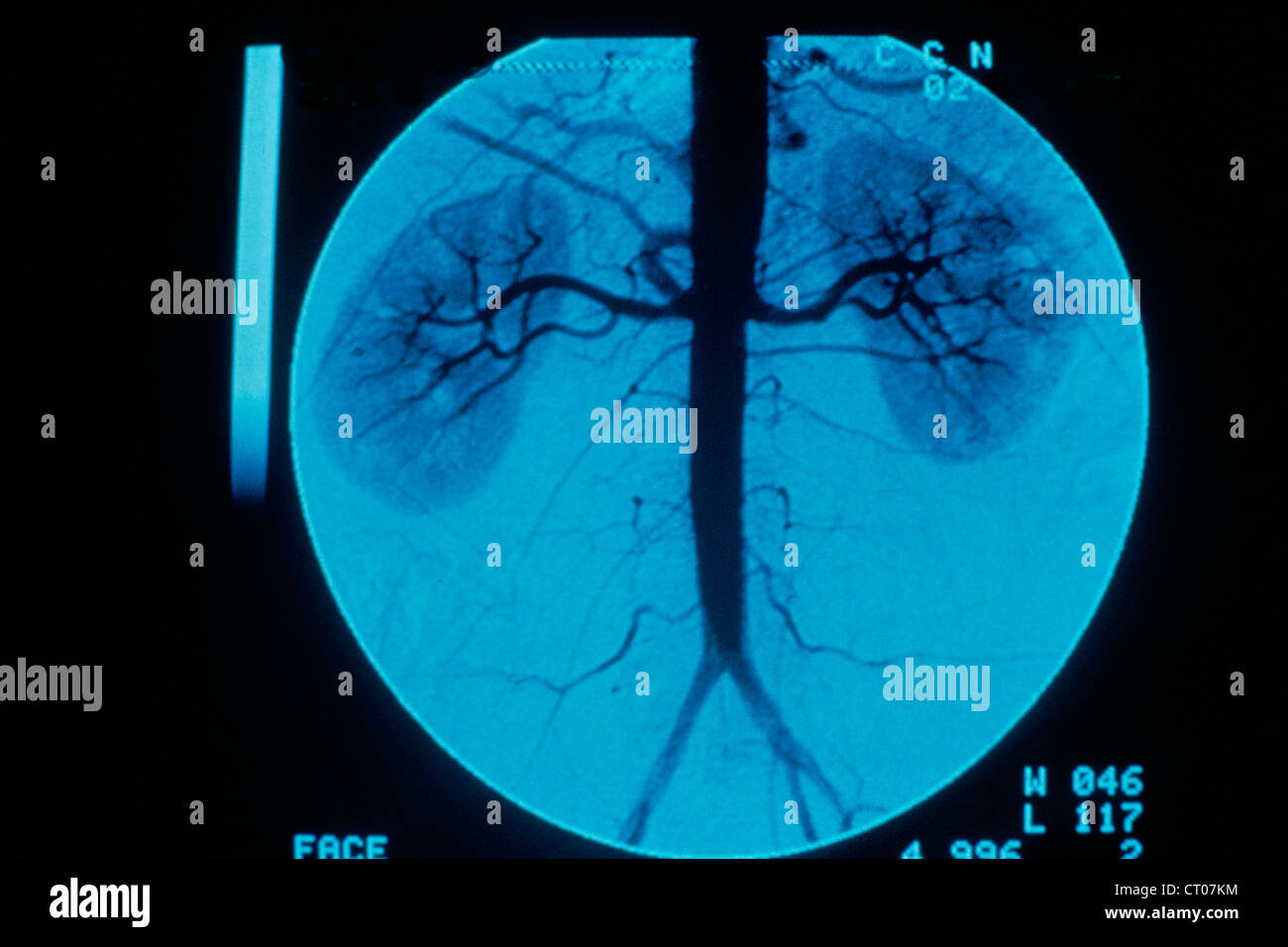 Angiogram normal kidney hi-res stock photography and images - Alamy