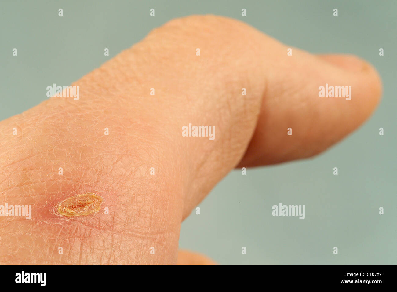 Cicatrization hi-res stock photography and images - Alamy