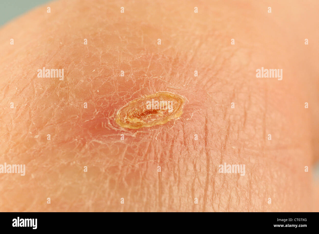 Cicatrization hi-res stock photography and images - Alamy