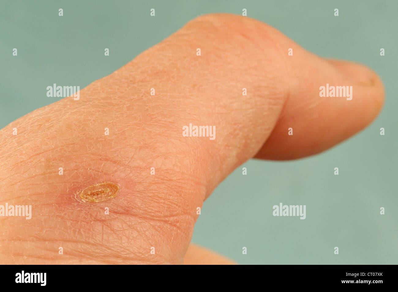 Cicatrization hi-res stock photography and images - Alamy