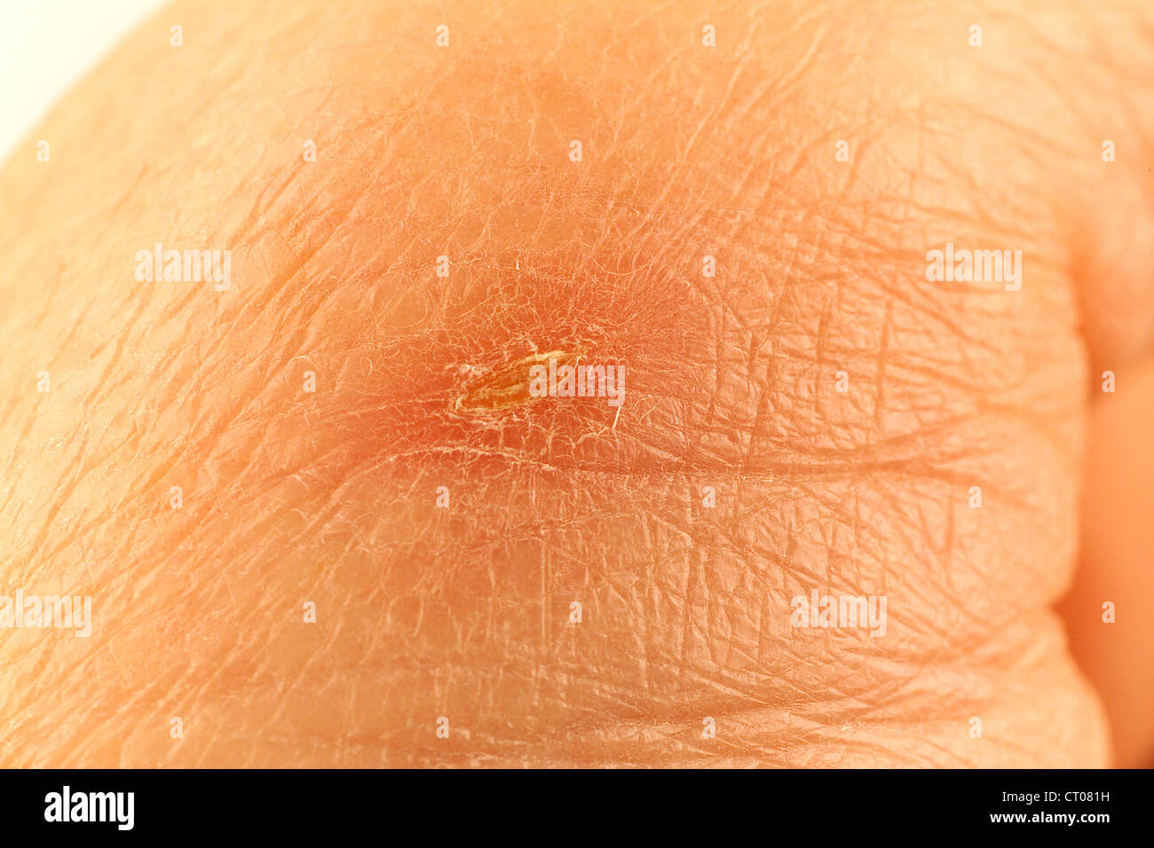 Cicatrization hi-res stock photography and images - Alamy