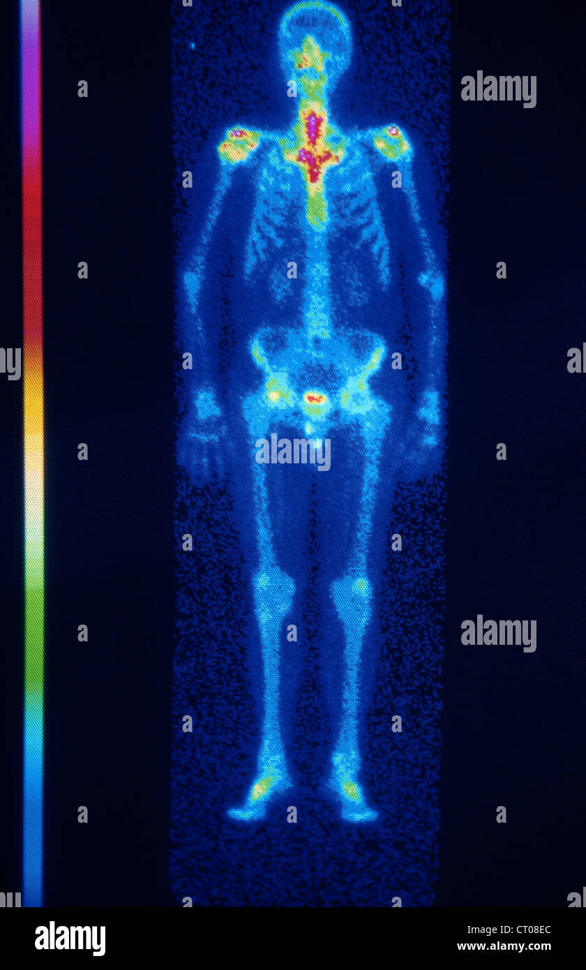 Gamma scan bone hi-res stock photography and images - Alamy