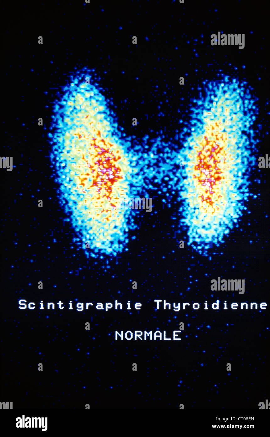 Scintigraphy thyroid hi-res stock photography and images - Alamy