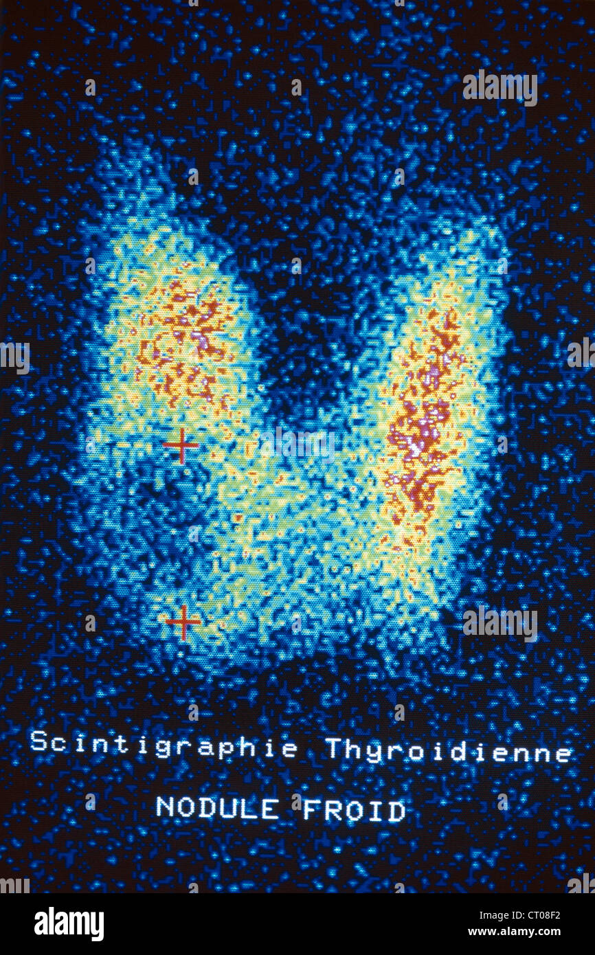 THYROID NODULE, SCINTISCAN Stock Photo - Alamy