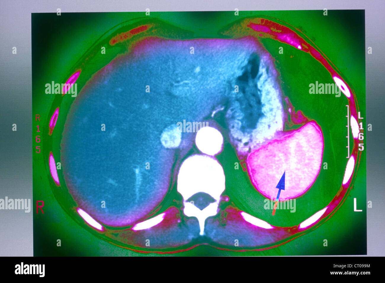 Spleen examining hi-res stock photography and images - Alamy