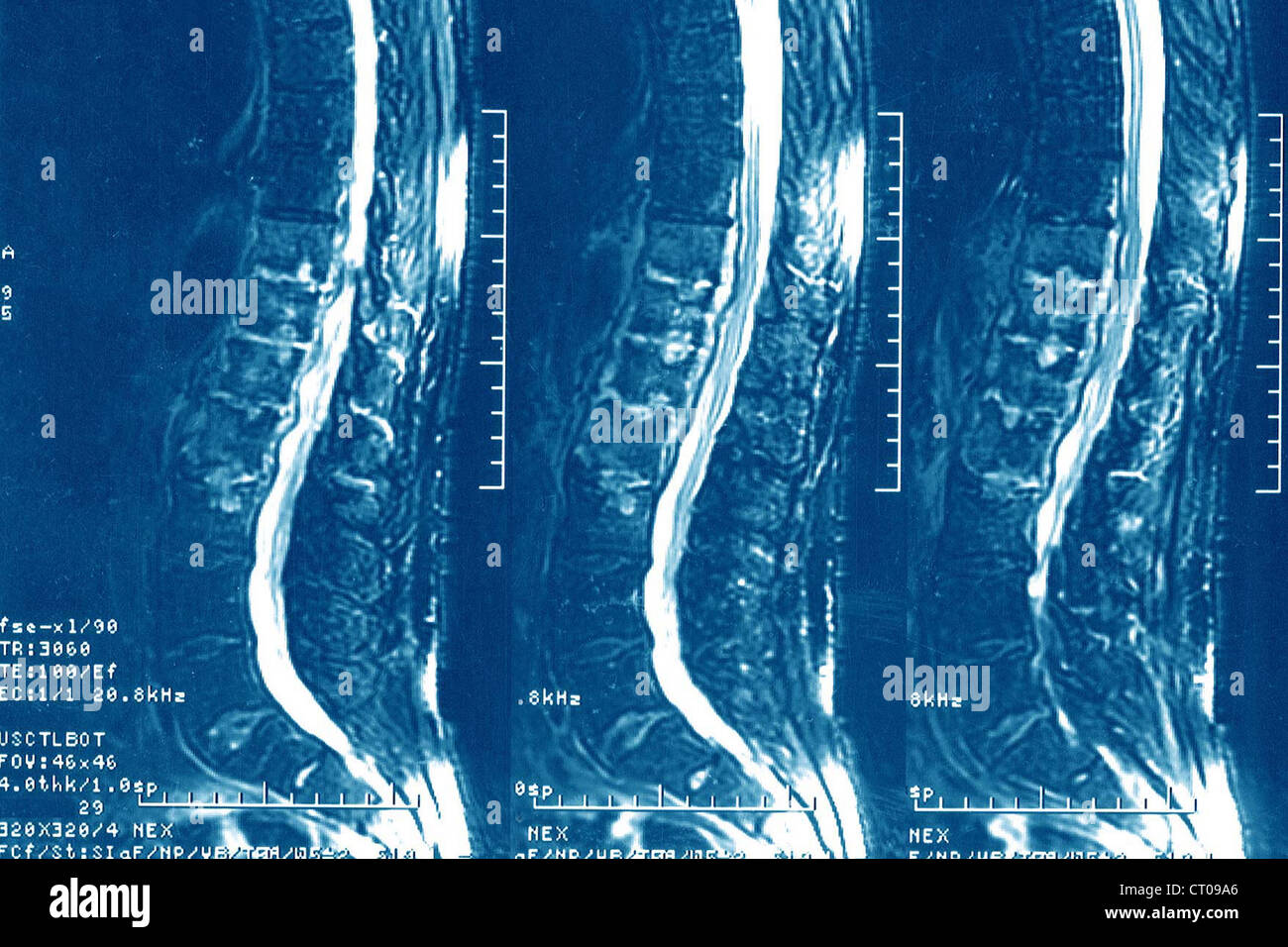 Spondylodiscitis mri hi-res stock photography and images - Alamy