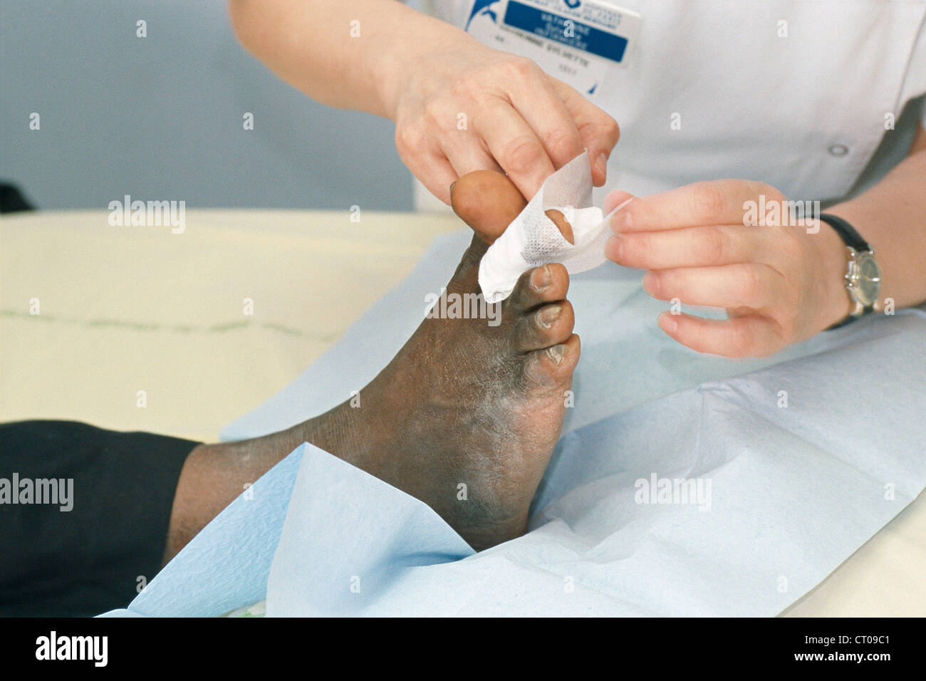 Necrosis foot hi-res stock photography and images - Alamy