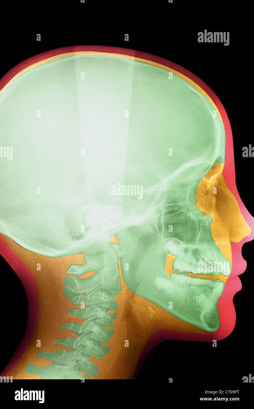X RAY OF HEAD Stock Photo - Alamy