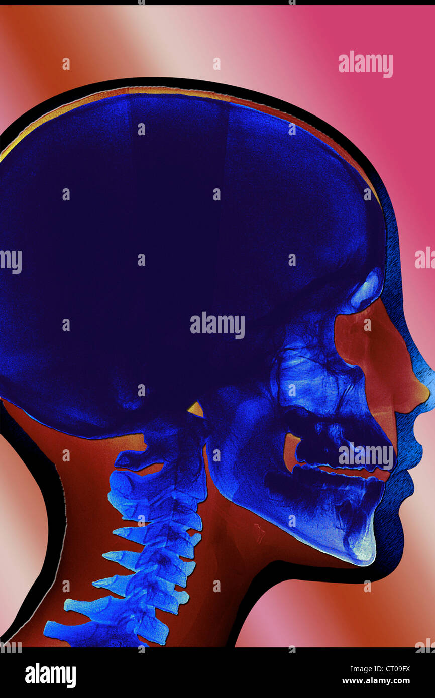 X RAY OF HEAD Stock Photo - Alamy