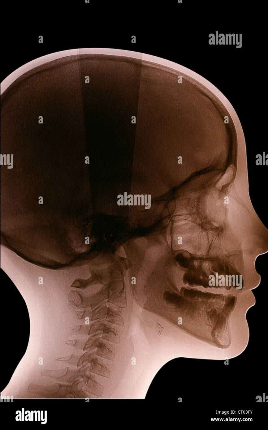 X RAY OF HEAD Stock Photo - Alamy