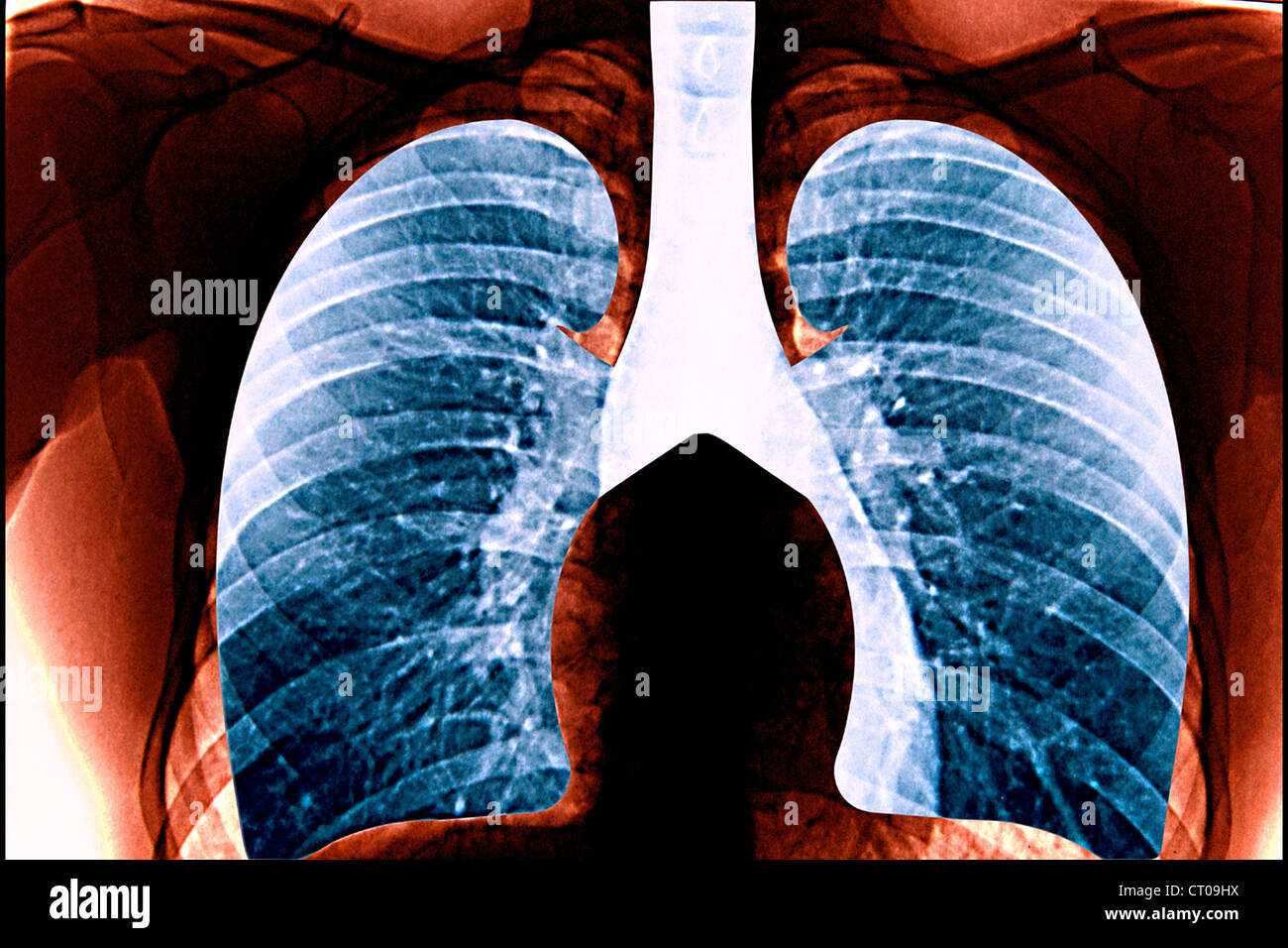 LUNG, X-RAY RESULT Stock Photo - Alamy