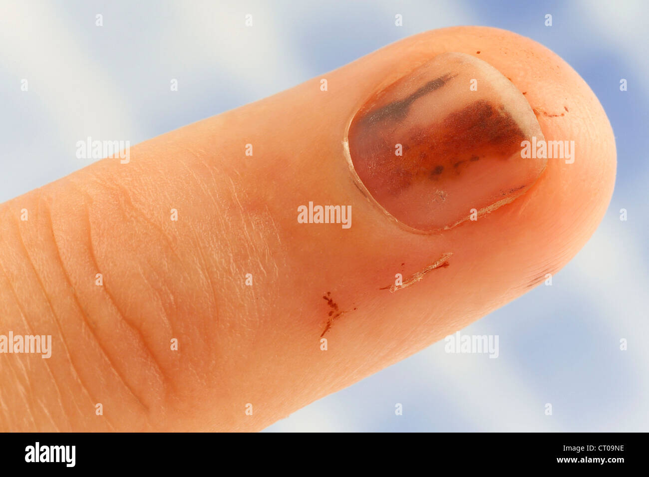 Open Sores Stock Photos & Open Sores Stock Images - Alamy