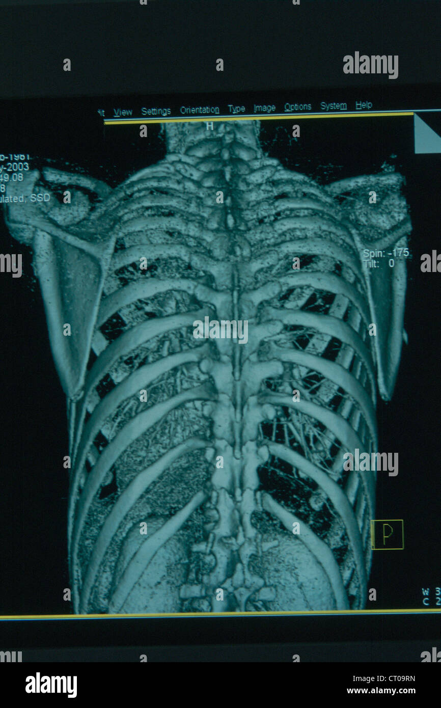 HELICAL CT SCANNER Stock Photo - Alamy