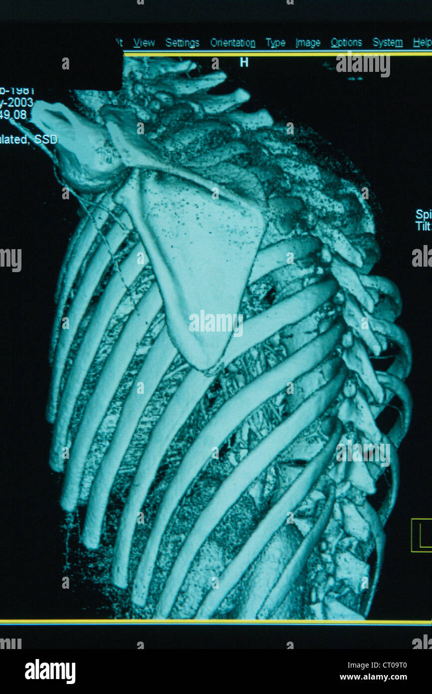 HELICAL CT SCANNER Stock Photo - Alamy