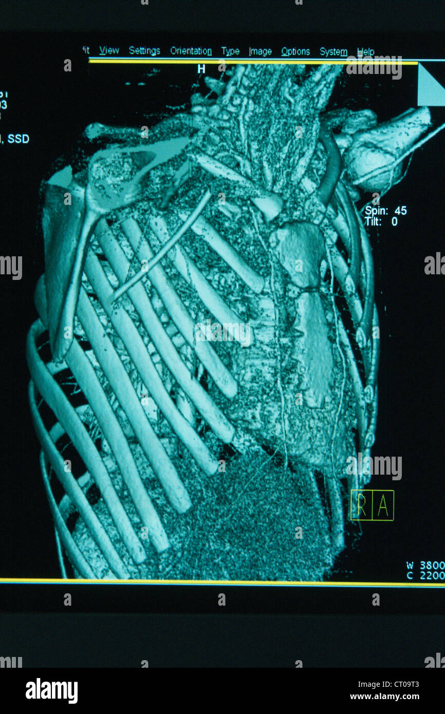 HELICAL CT SCANNER Stock Photo - Alamy