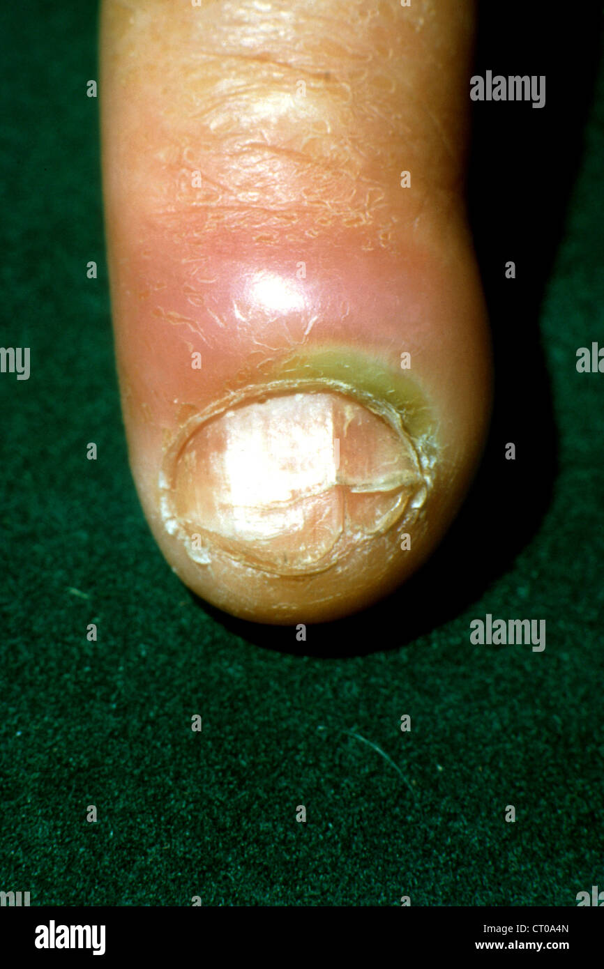 Paronychia infection hi-res stock photography and images - Alamy