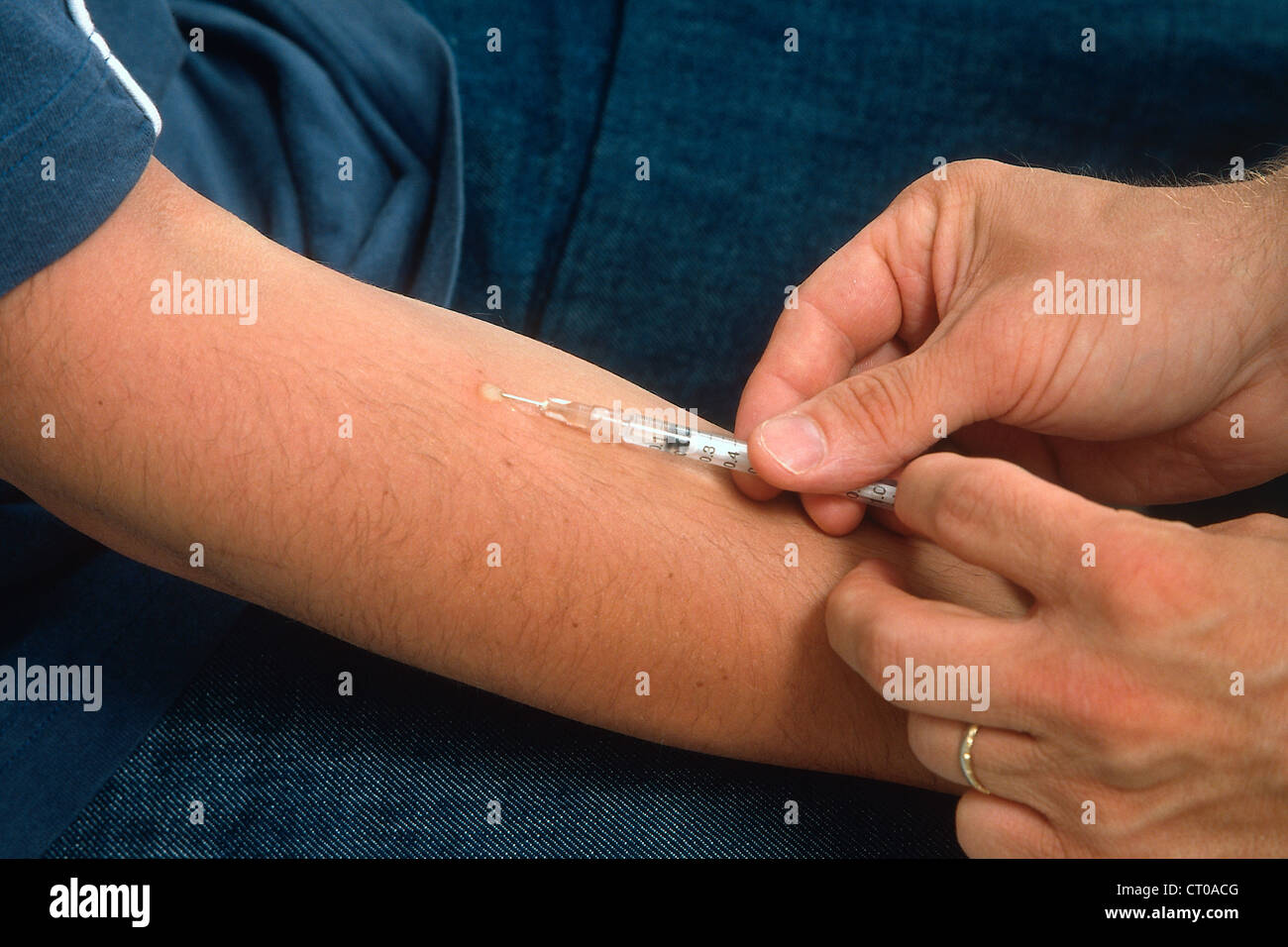 Allergy skin test needle hi-res stock photography and images - Alamy