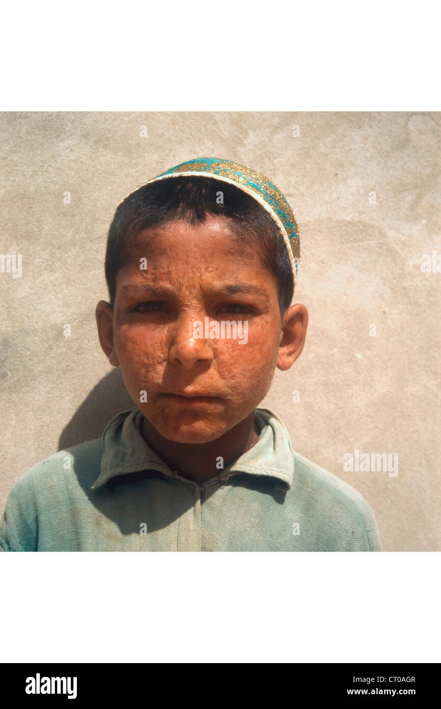 Person with smallpox hi-res stock photography and images - Alamy