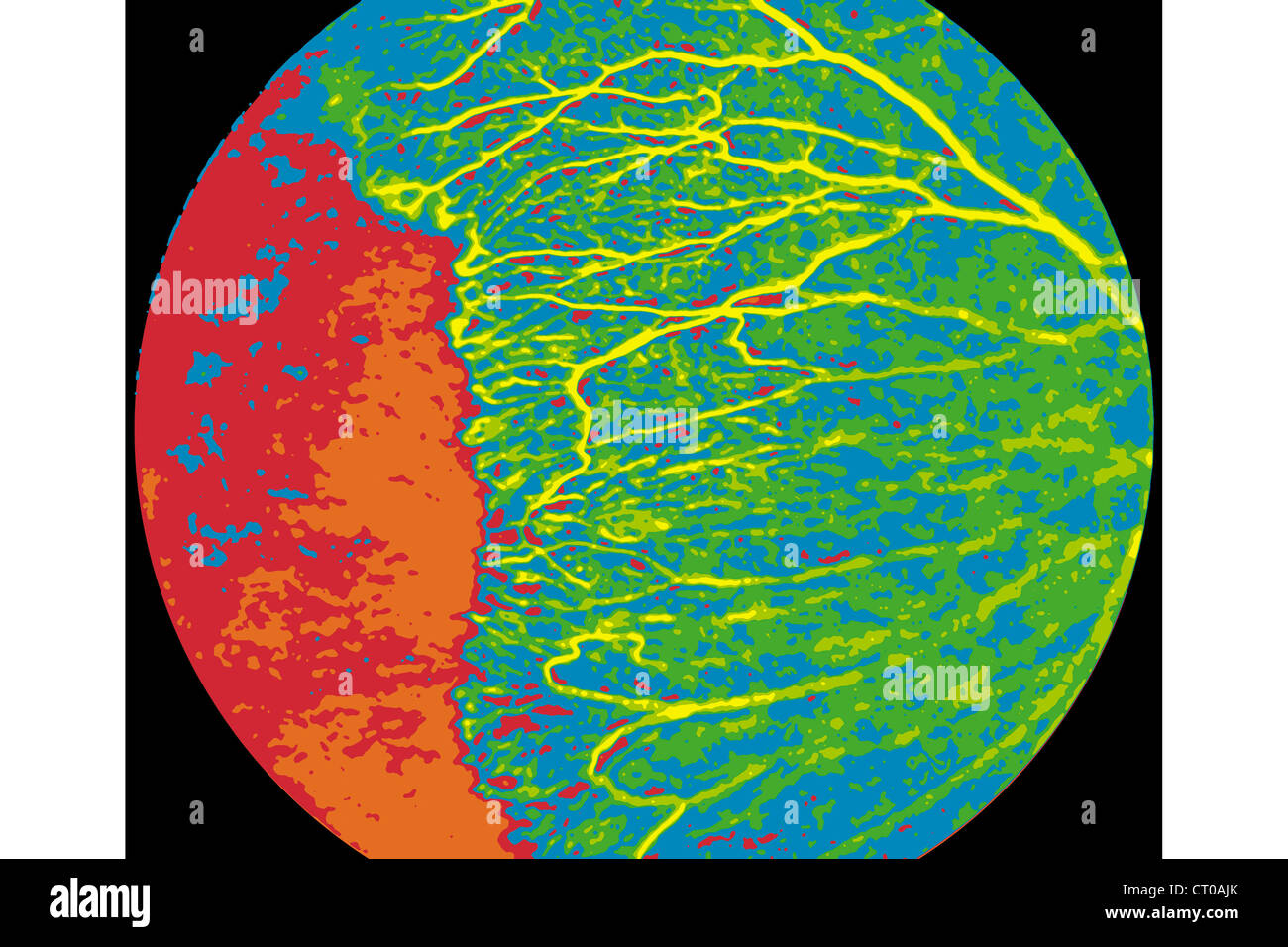 PREMATURE BABY RETINOPATHY Stock Photo - Alamy