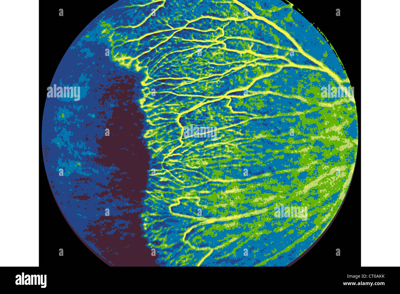 PREMATURE BABY RETINOPATHY Stock Photo - Alamy