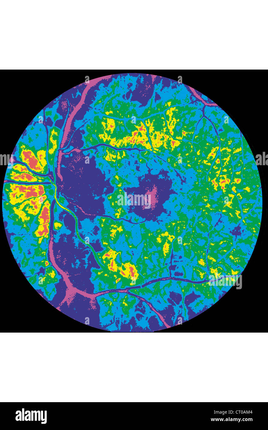 Retinal photography hi-res stock photography and images - Alamy