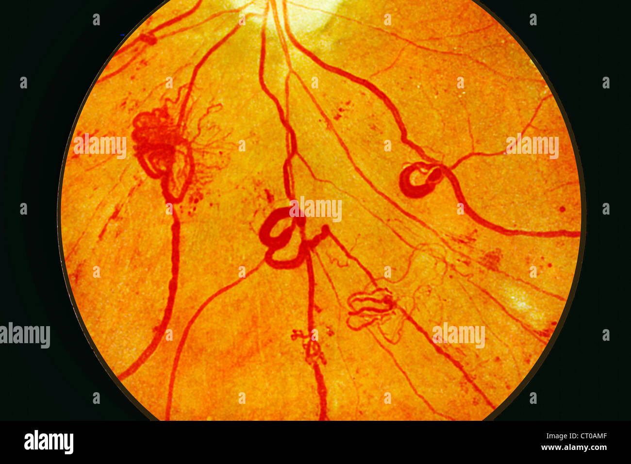 DIABETIC RETINOPATHY Stock Photo - Alamy DIABETIC RETINOPATHY Stock Photo - Alamy