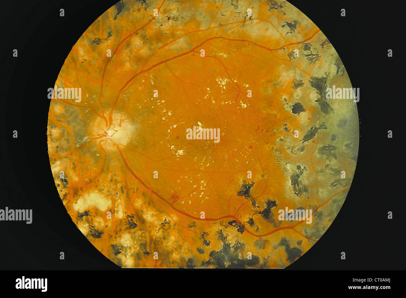 DIABETIC RETINOPATHY Stock Photo - Alamy DIABETIC RETINOPATHY Stock Photo - Alamy