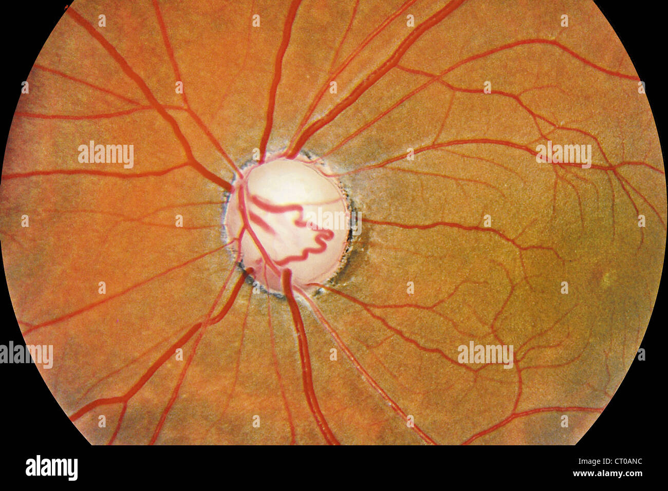 Optic atrophy hi-res stock photography and images - Alamy