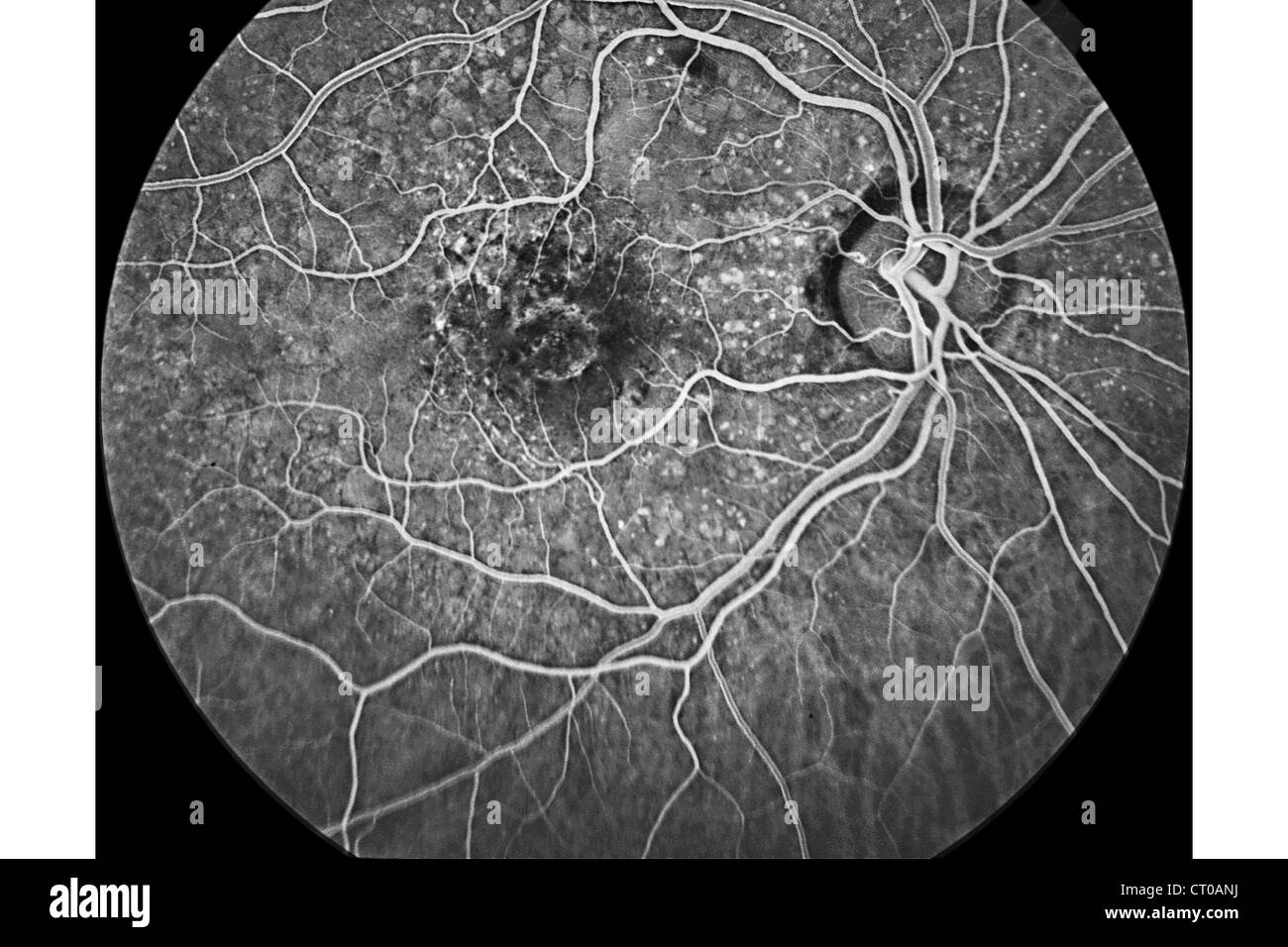 Eyes macula degeneration Black and White Stock Photos & Images - Alamy